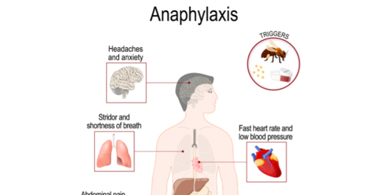 Anaphylaxis – causes, symptoms, emergency treatment – Healthcert Education