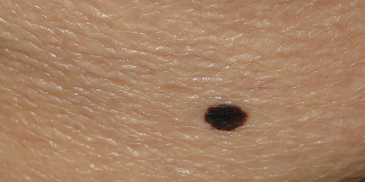 Dermoscopy for difficult benign lesions including nevi with special fe ...