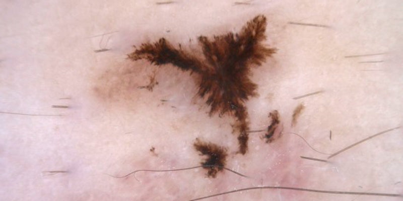 The broad spectrum of BCC and keratinocyte skin cancer – HealthCert ...