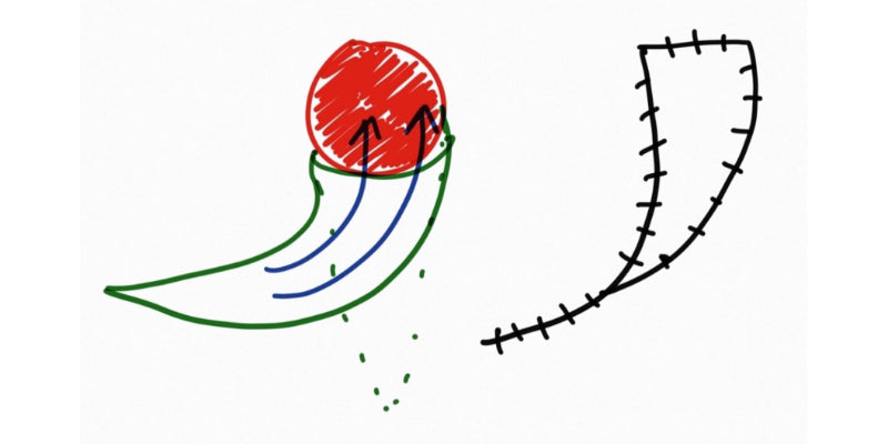 V-Y Flaps – Healthcert Education