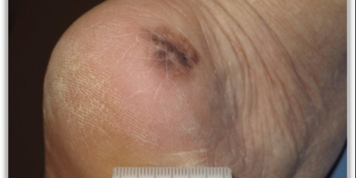 Types of lesions - Flat/nodular, pigmented/non-pigmented – Healthcert ...