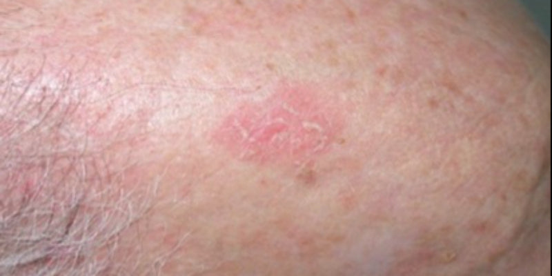 An approach to non-pigmented skin lesions – Healthcert Education