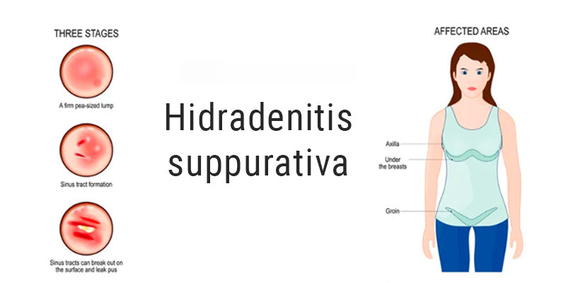 Hidradenitis suppurativa diagnosis and treatment – Healthcert Education